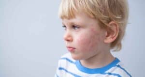 What is Mastocytosis? Types, Symptoms, and Treatment - Allergy & Asthma ...