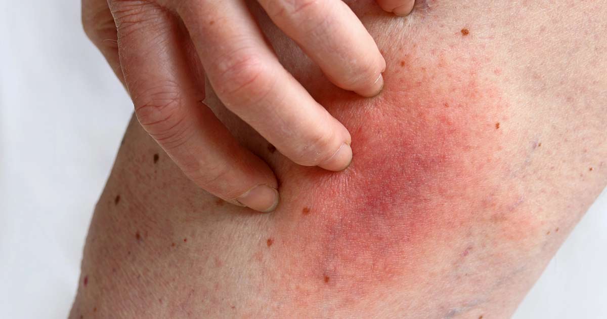 Insect Sting Allergy - Allergy & Asthma Network