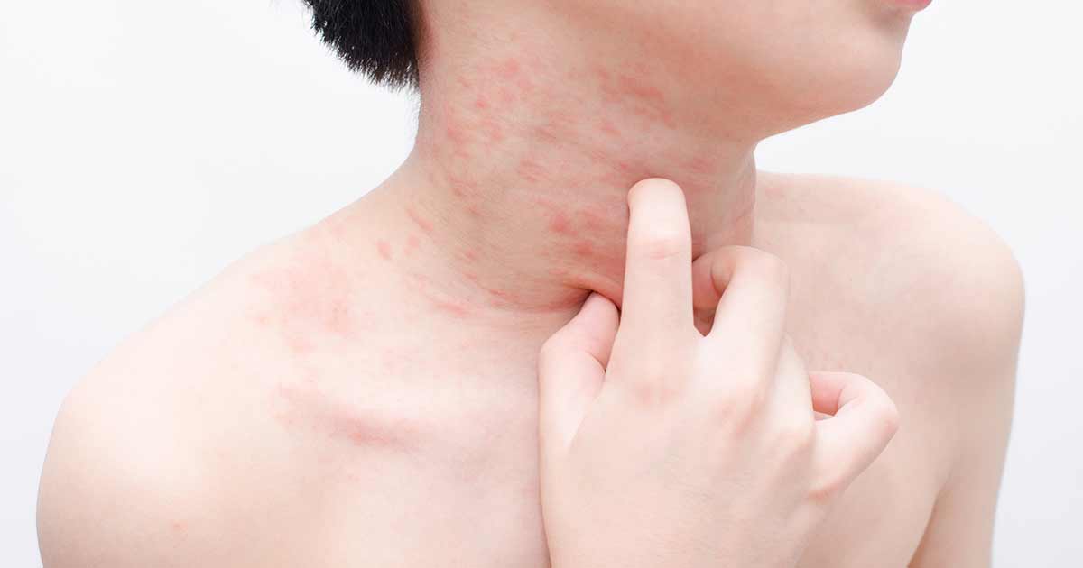 Chronic Urticaria: Causes, Symptoms, Diagnosis, & Treatment - Allergy ...