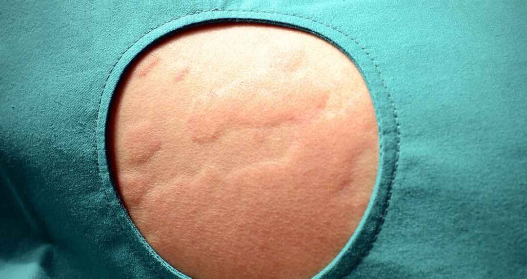 Chronic Hives: 10 Actions to Support Your Mental Health - Allergy ...