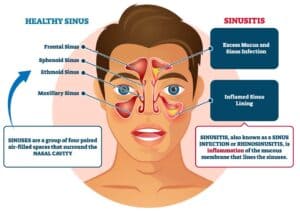 Sinusitis - Allergy & Asthma Network