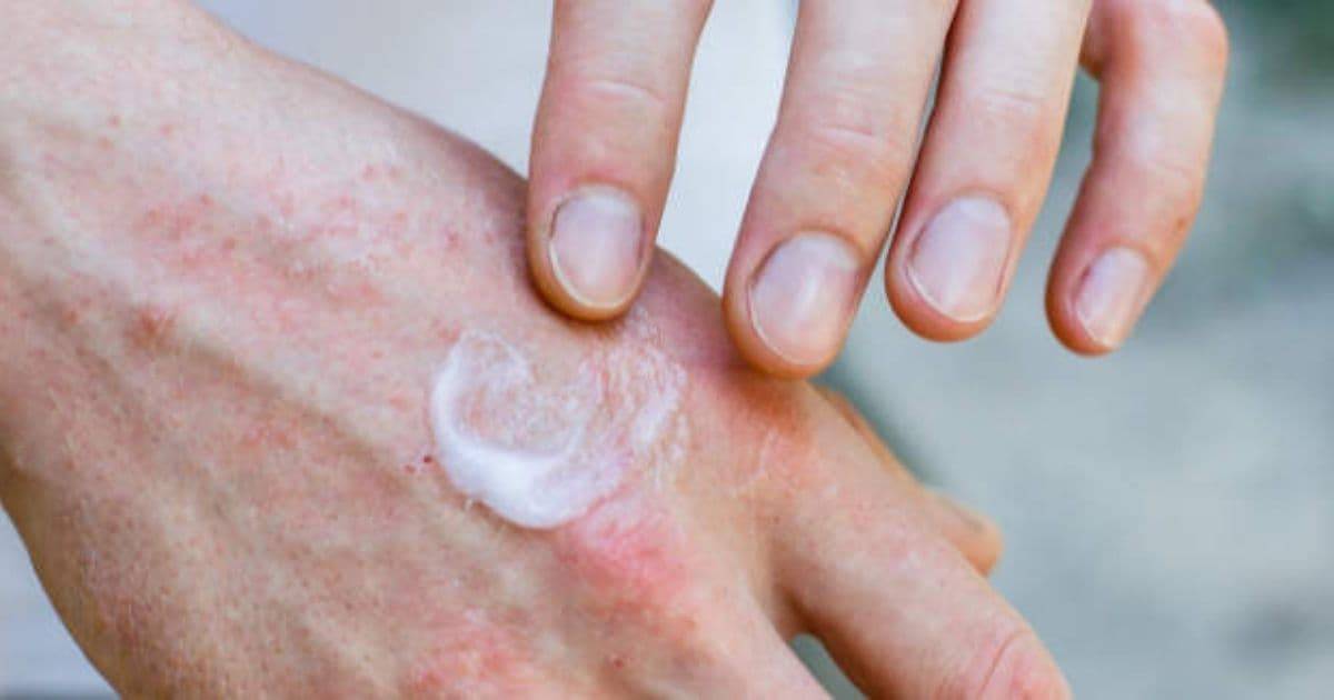 Eczema On Knuckles Hand Eczema, Hand Dermatitis