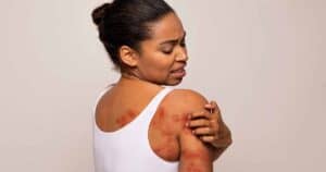 What is Mastocytosis? Types, Symptoms, and Treatment - Allergy & Asthma ...