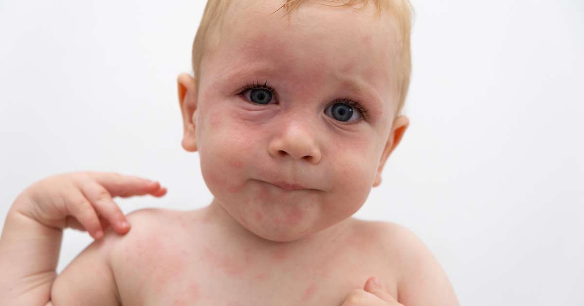 Infant Anaphylaxis: Causes, Symptoms, and Treatment Guide - Allergy ...