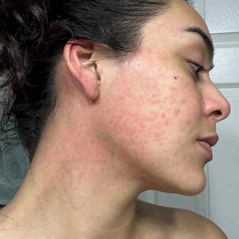 Hives on Black Skin and Other Skin of Color - Allergy & Asthma Network